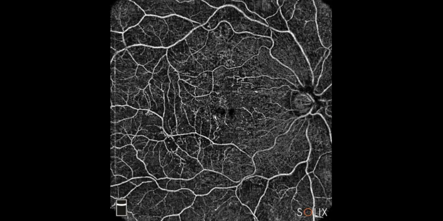 Optovue Solix OCT-A (Optical Coherence Tomographer with Angiography)