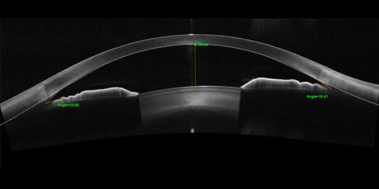 Optovue Solix OCT-A (Optical Coherence Tomographer with Angiography)