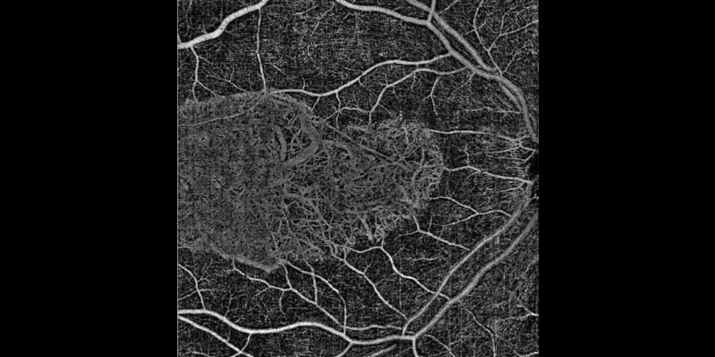 Optovue Solix OCT-A (Optical Coherence Tomographer with Angiography)