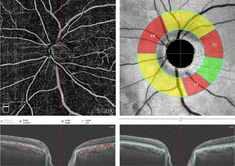 Visionix | OCT - Discover all our Tomography products.
