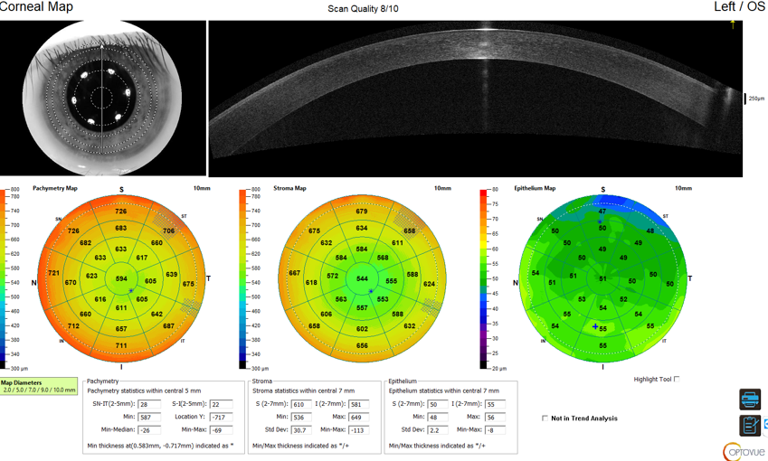 New Topography Module Available On Optovue Solix Visionix