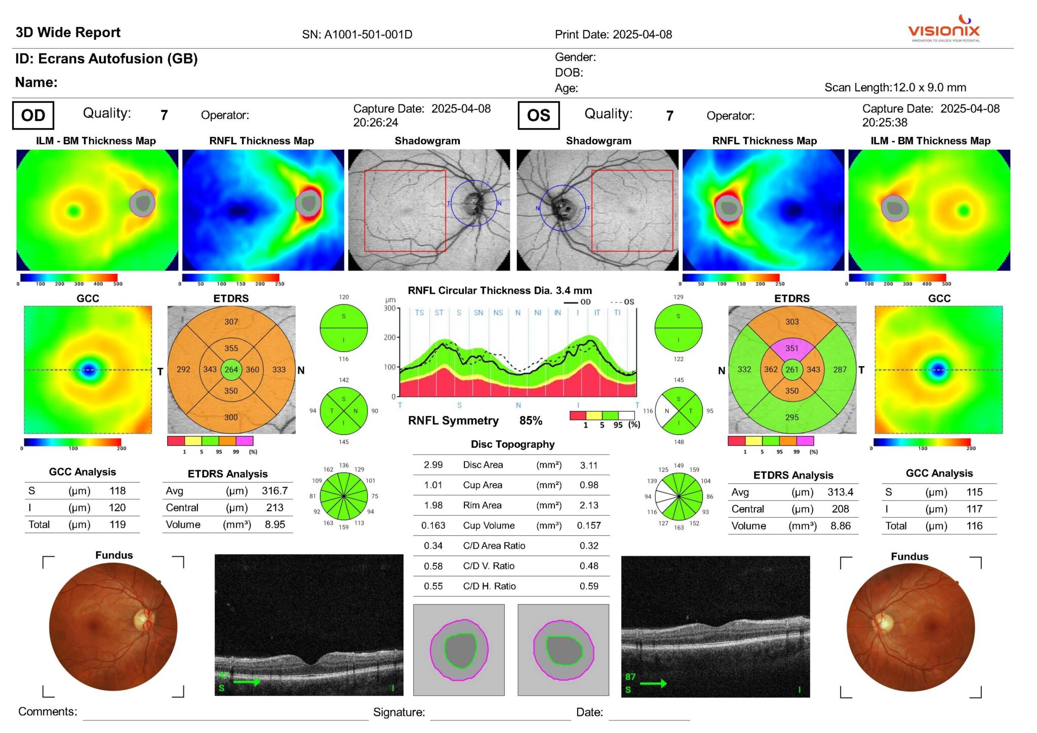 Visionix | Optovue Autofusion OCT